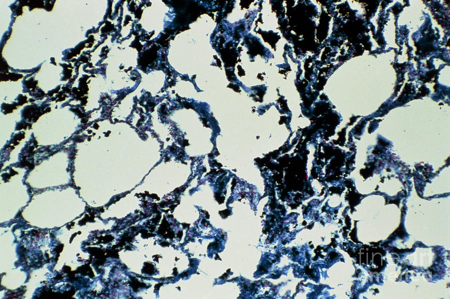 Lm Of Lung Tissue Containing Coal Particles Photograph by Astrid & Hanns-frieder Michler/science ...