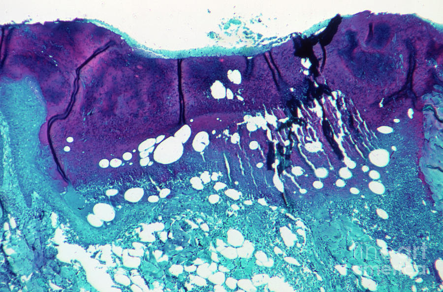 Monkeypox Lesion by Science Photo Library