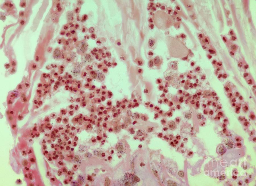 Odontogenic Cyst Photograph By Steve Gschmeissnerscience Photo Library Fine Art America