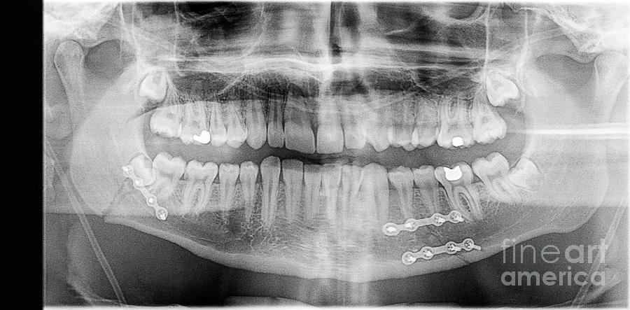 Orthopantomogram Photograph by Science Photo Library - Fine Art America