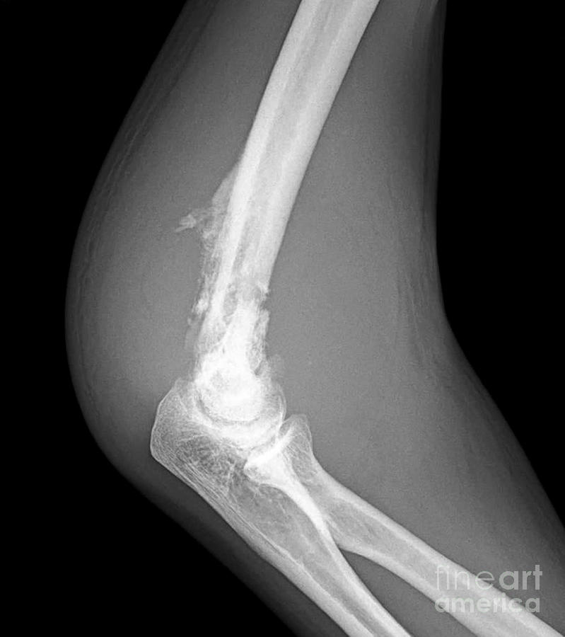 Osteosarcoma Of The Distal Humerus Photograph by Science Photo Library ...