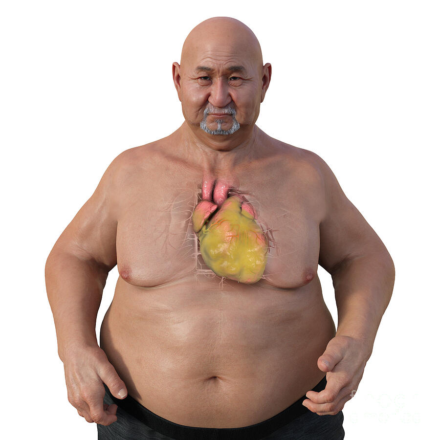 Overweight Man With Obese Heart by Kateryna Kon/science Photo Library