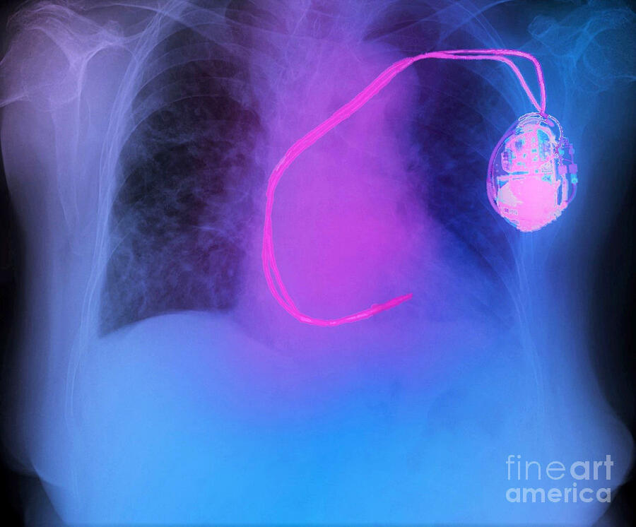 Pacemaker by Rajaaisya/science Photo Library