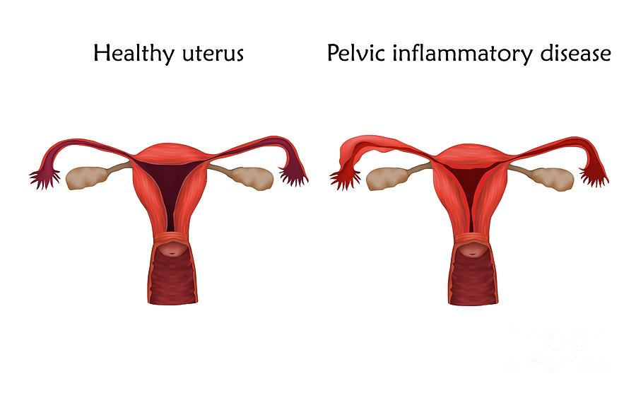 Pelvic Inflammatory Disease Photograph By Veronika Zakharova Science