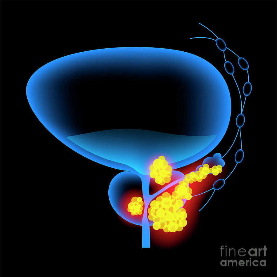 Prostate Cancer Photograph By Pikovit Science Photo Library Pixels
