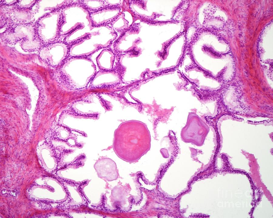 Prostatic Concretions Photograph By Jose Calvo Science Photo Library