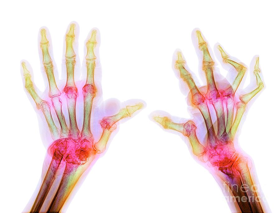 Rheumatoid Arthritis Of The Hands Photograph by Science Photo Library ...