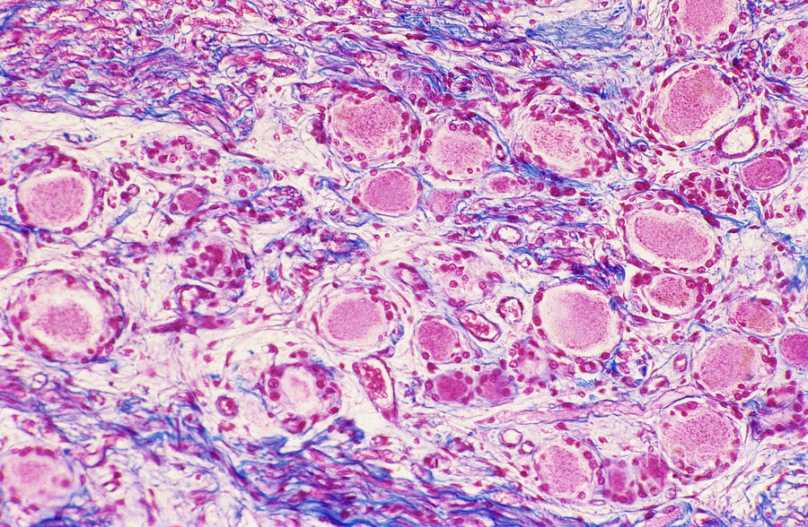 Spinal Nerve Ganglion Photograph by Astrid & Hanns-frieder Michler/science Photo Library - Fine ...