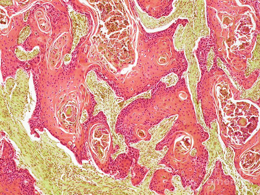 Squamous Cell Carcinoma Of The Vulva Photograph By Steve Gschmeissner