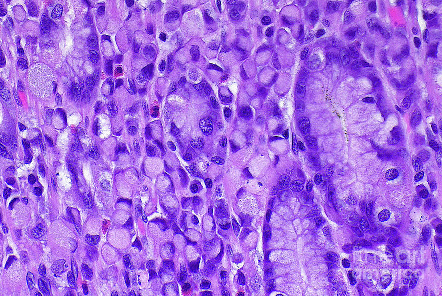 Stomach Adenocarcinoma Cells Photograph by Ziad M. El-zaatari/science ...