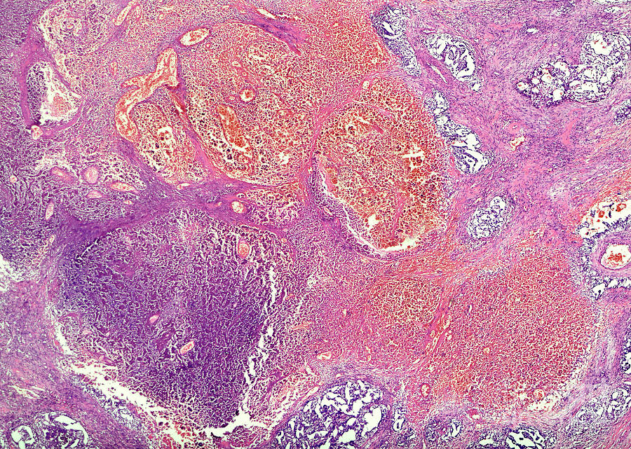 Testicular Germ Cell Tumour Photograph By Nigel Downer Science Photo