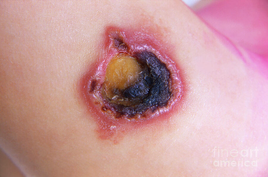 Ulcer Caused By Pyoderma Gangrenosum by Dr. Hudson, Cdc/science Photo Library