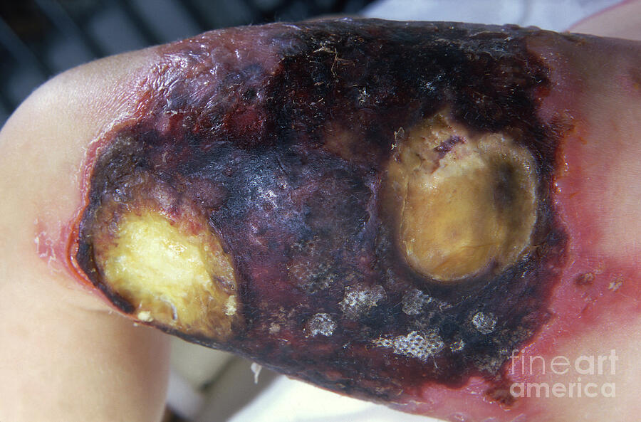 Ulcers Caused By Pyoderma Gangrenosum by Dr. Hudson, Cdc/science Photo Library