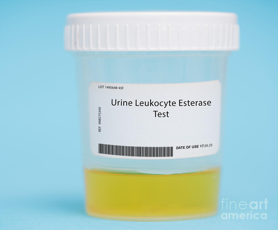 Urine Leukocyte Esterase Test by Wladimir Bulgar/science Photo Library